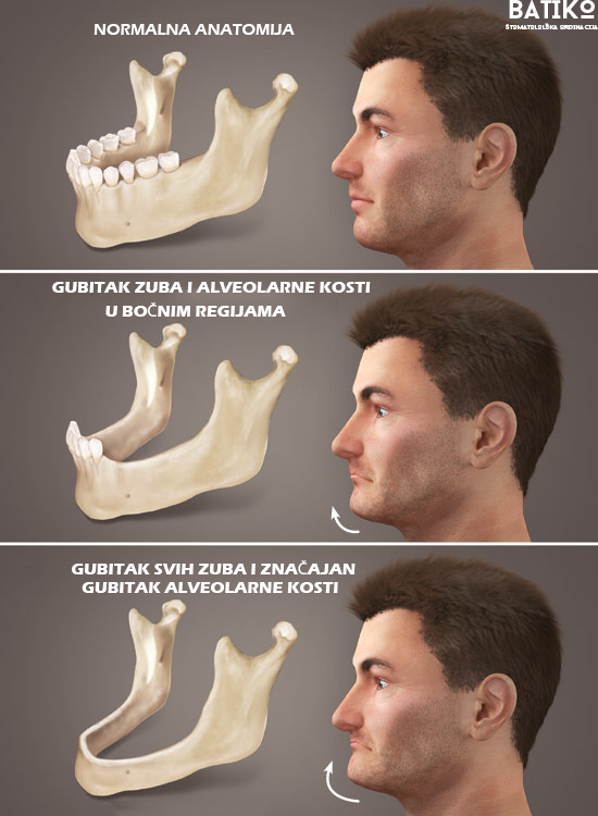 Posledice i terapija gubitka zuba | BATIKO